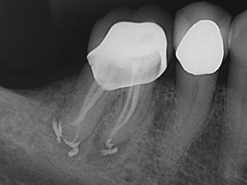 Clinical Evidence Of Gentlewave® Procedure Efficacy